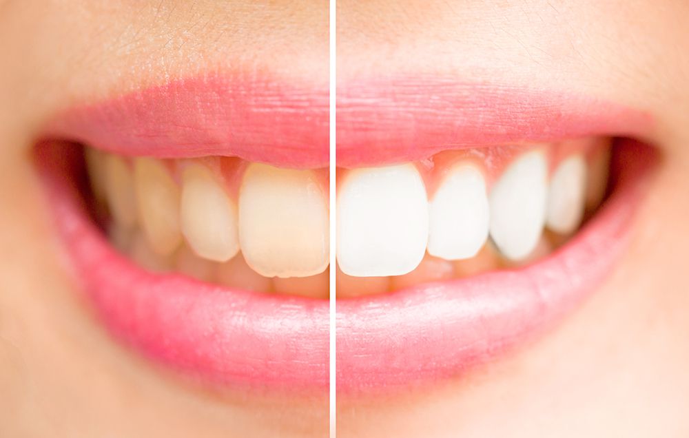 SmilePerfectors Offer Advanced Teeth Whitening Treatment in Tysons ...